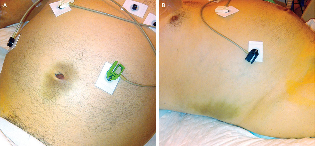 پانکراتیت حاد چیست؟ + تشخیص و مراقبت‌های التهاب پانکراس - آموزش پرستاری ...